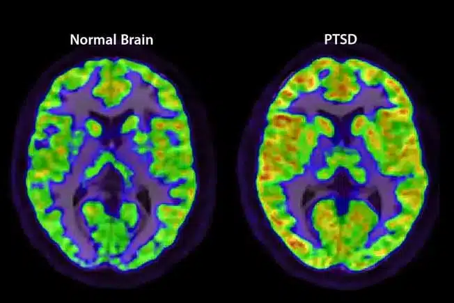 Tms For Ptsd How It Is Transforming Recovery Neuralia Tms