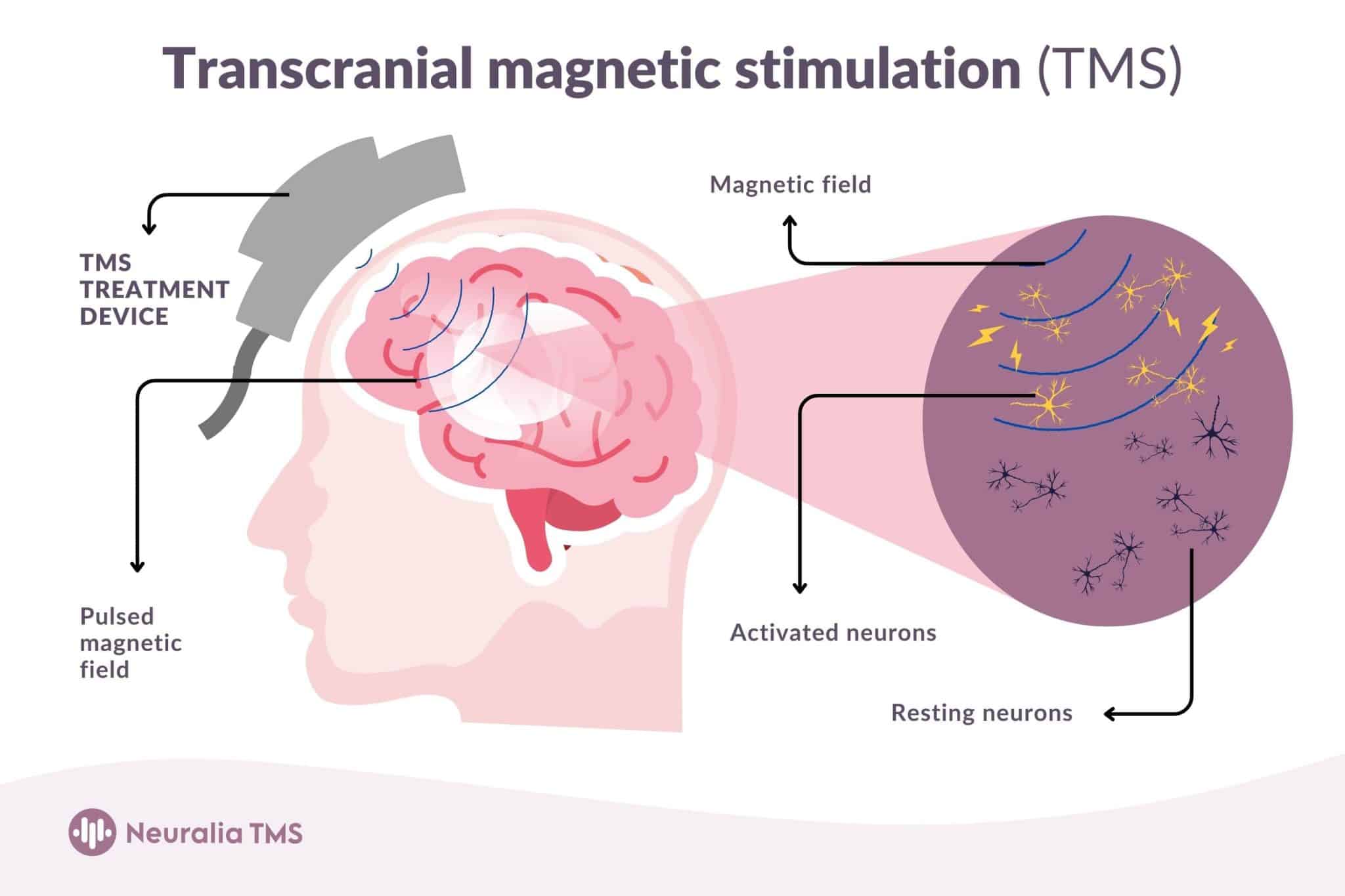 Tms Treatment For Depression In Perth Tms Therapy Clinic
