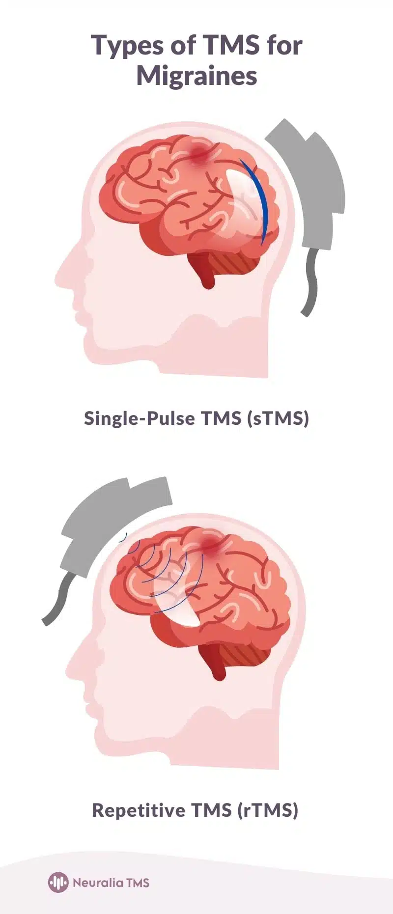 TMS treatment for Migraines | TMS Therapy Clinic